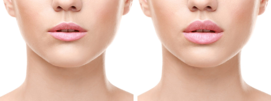 Lips Augmentation Derma Fillers Marcos Derma Care Botox Filler