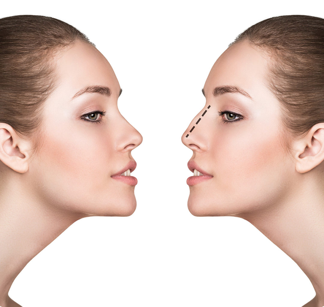 Non-surgical Nose Correction | Marco's Derma Care: Botox, Filler, PRP ...